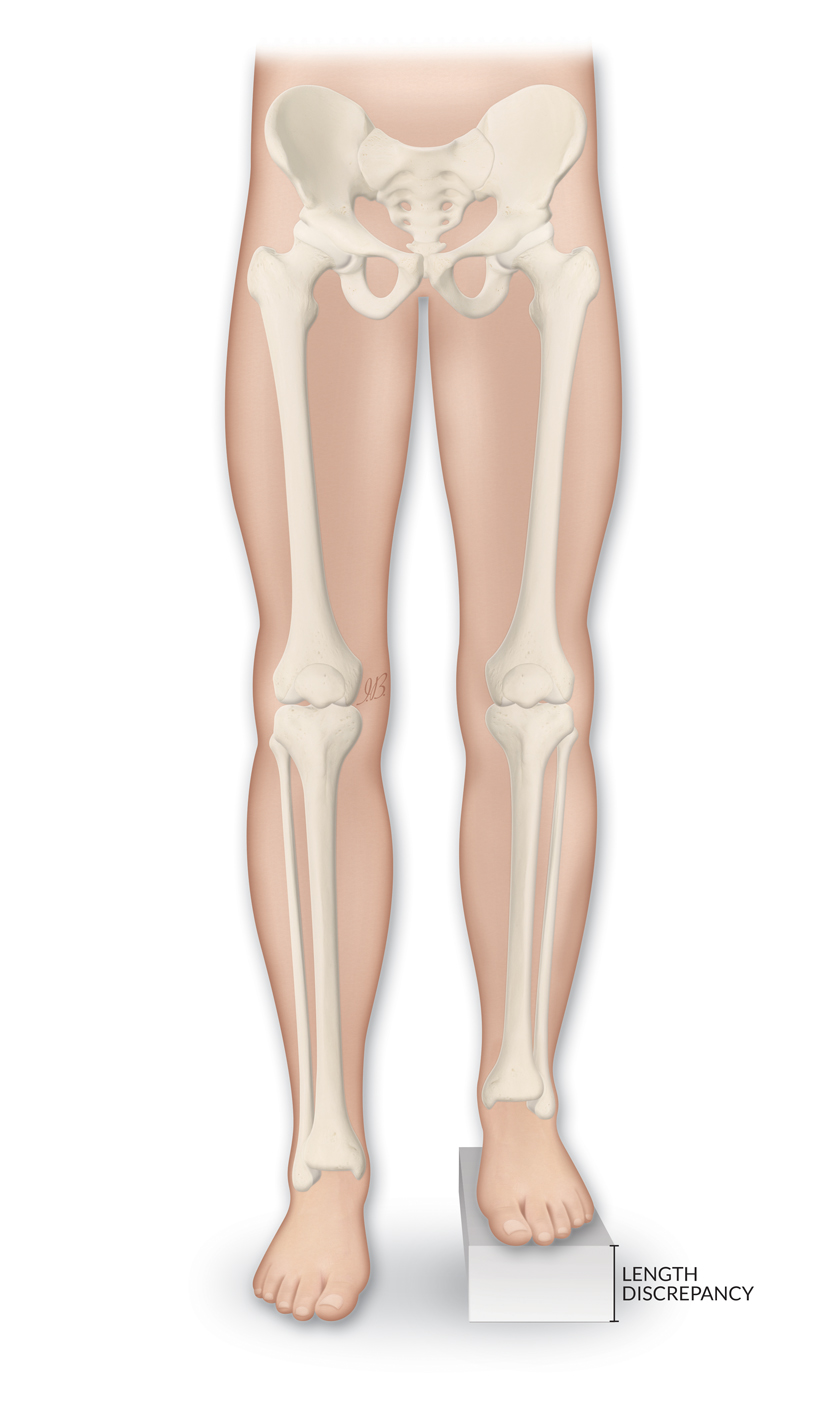 Leg Length Discrepancy LLD Limbhealing Leg Length Discrepancy LLD Limbhealing